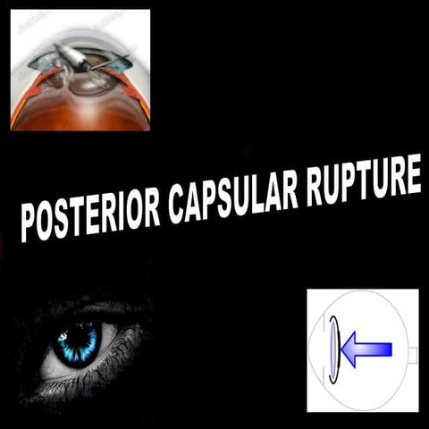 Posterior capsular rupture | PPT