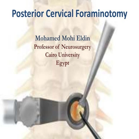 Posterior foraminotomy for cervical disc herniation | PPTX