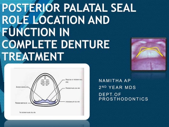 Posterior palatal seal 2nd yr | PPT