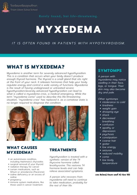 Myxoedema | PPT