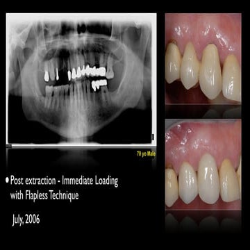 Immediate post estractive Implant | KEY