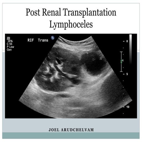 Post_Renal_Transplantation_lymphocele, Joel Arudchelvamceles.pptx