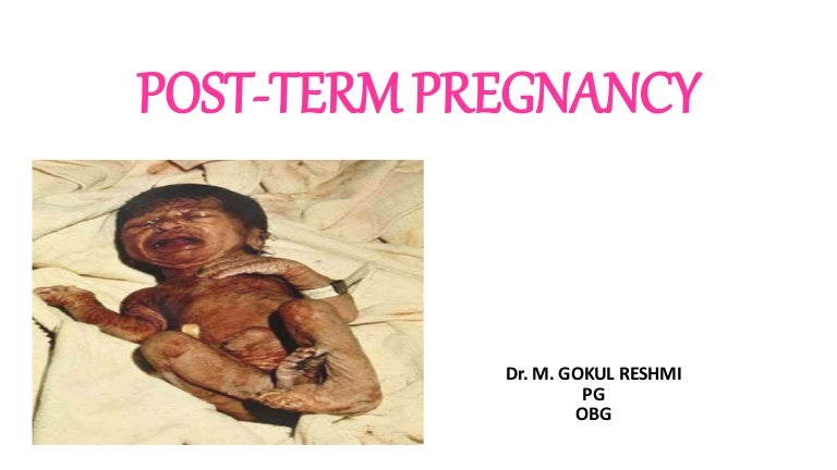 Postterm pregnancy