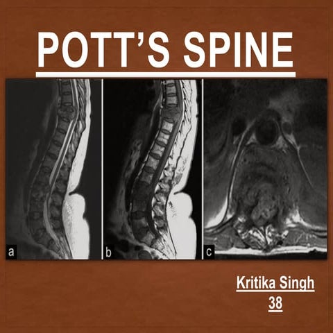 potts disease and its treatment and nursing management .pptx