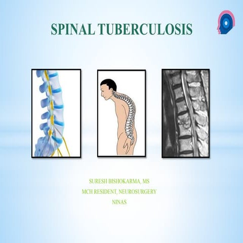 Potts spine- TB spine. | PPT