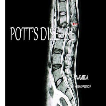 POTTS SPINE /TUBERCULOSIS SPINE (TB SPINE ).pptx