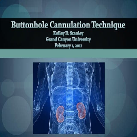 Buttonhole Cannulation Technique Power Point | PPTX
