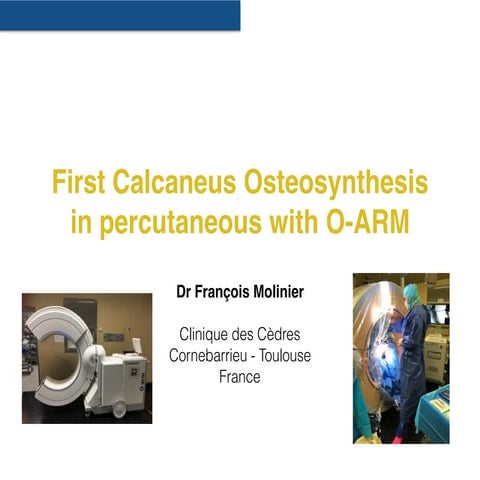 Calcaneus osteosynthesis with O-arm | PDF