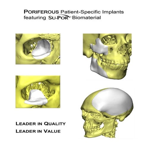 Poriferous Patient-Specific Implants | PDF