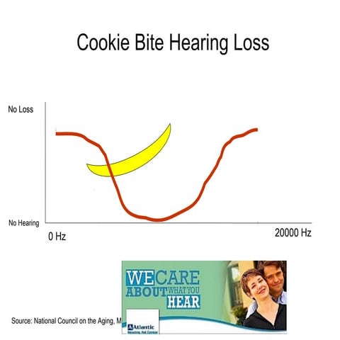 Cookie Bite Hearing Loss | ODP
