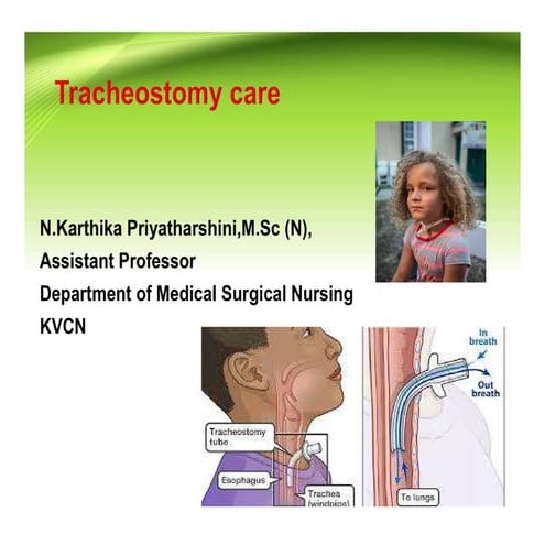 PPT-TRACHEOSTOMY.pdfkkkkjjjjjjjjjjjjjhhhhhh | PDF