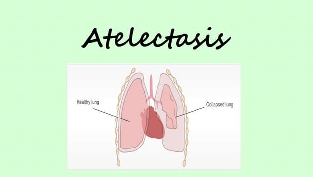 Atelectasis Diagram