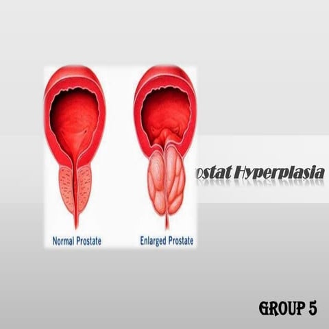 benign prostat hyperplasia | PPTX