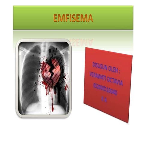 Ppt Emfisema | PPTX