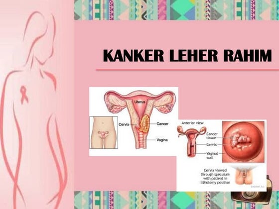 PPT kanker serviks | PPTX