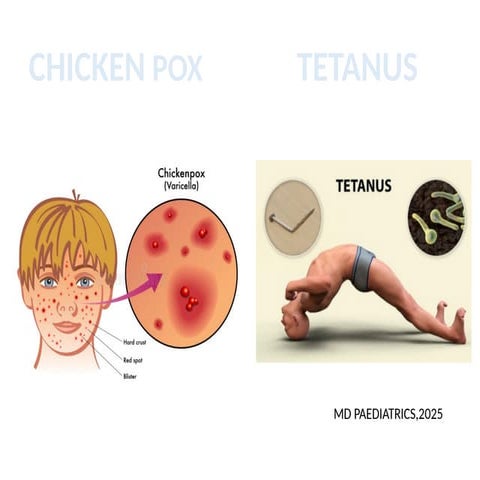 ppt of paediatric chicken pox and tetanus with vignette.pptx