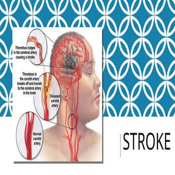 PPT materi dari patofisiologi stroke .ppt
