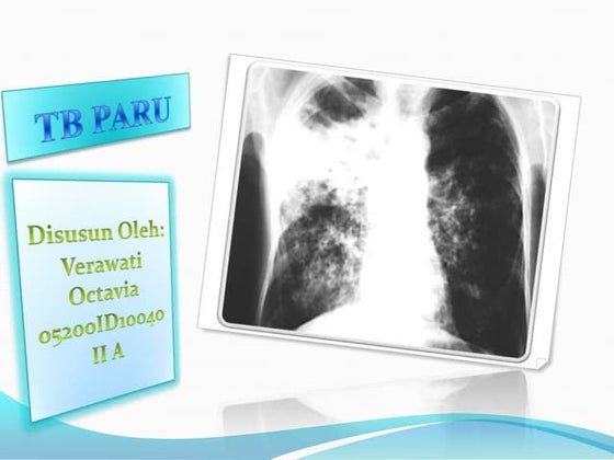 Tuberculosis | PPT