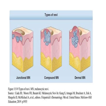 PPT Types of Common Acquired Melanocytic Nevi.pptx