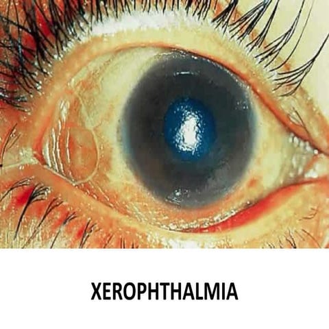 ppt xeropthalmia.pptx | Eye and Vision Conditions | Diseases and Conditions