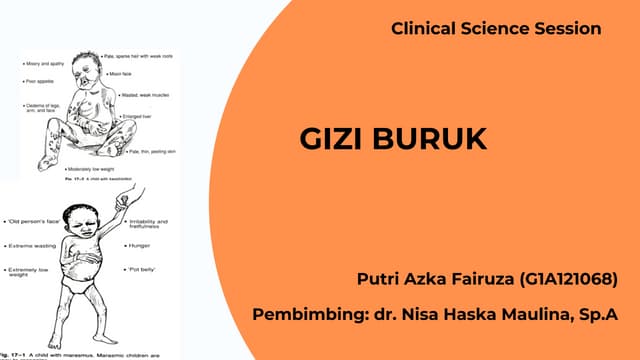 Tatalaksana Gizi Buruk.pptx
