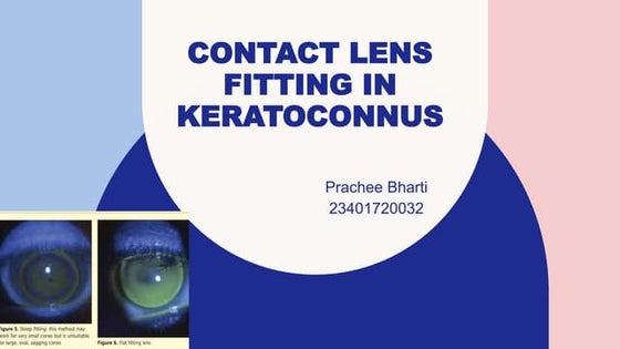 Soft Toric Contact lens | PPT