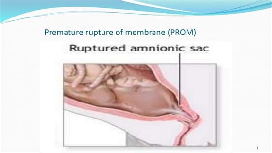 Premature rupture of membranes (PROM) | PPTX