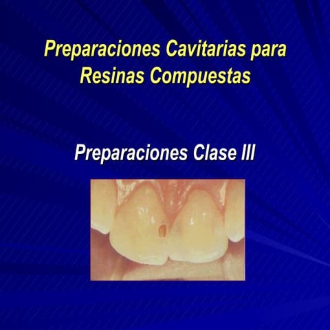 Prep. cav. y rest. clase iii para resinas 330a 2005 | PPT