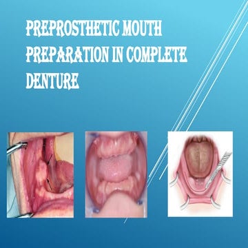 Preprosthetic mouth preparation in COMPLETE DENTURE.pptx