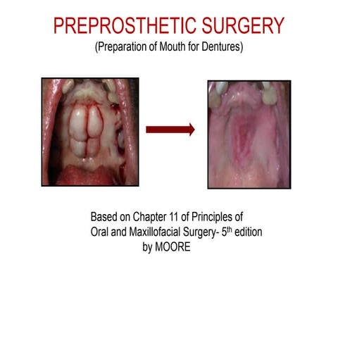 Pre Prosthetic Surgery | PPTX