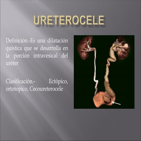 Presentacion de urocele en plenario medico | PPT