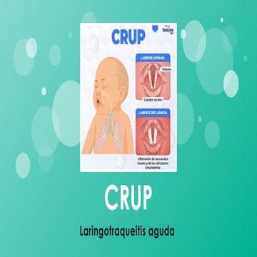 Laringotraqueitis aguda/ CRUP. Diapositiva | PPTX