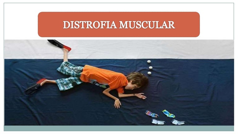 Presentacion distrofia muscular