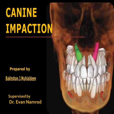 CANINE IMPACTION 1.pptx
