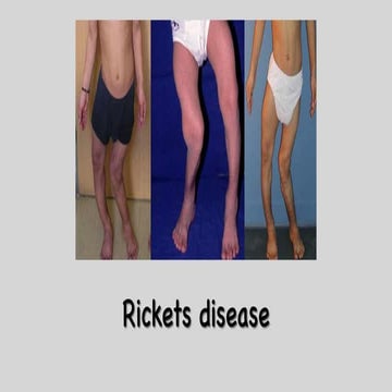 Rickets disease | PDF