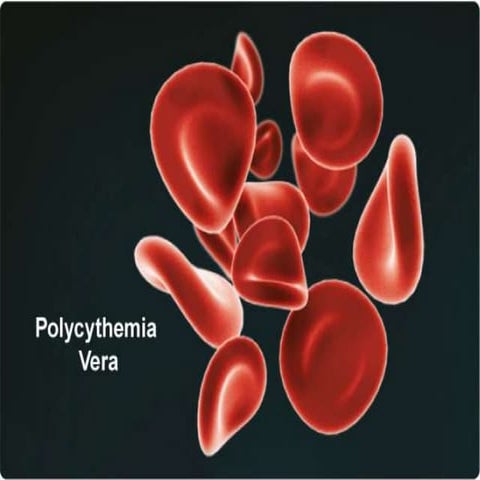 Polycythemia Rubra Vera | PPTX | Blood Disorders | Diseases and Conditions