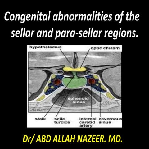 Presentation1.pptx, congenital abnormality of the sellar and para ...