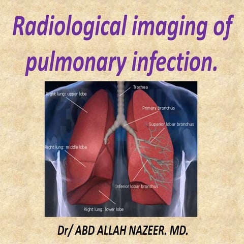 Presentation1.pptx, radiological imaging of pulmonary infection. | PPTX