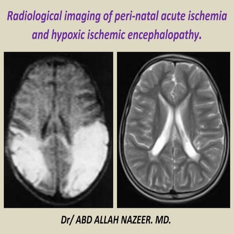 Presentation1.pptx, radiological imaging of peri natal acute ischemia ...