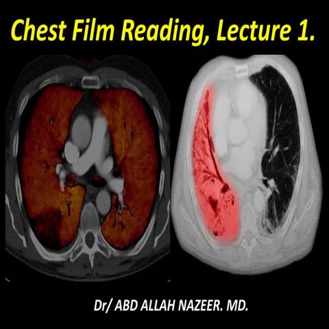 Presentation1.pptx, chest film reading. lecture 1 | PPTX | Lung and ...