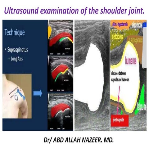 Presentation1.pptx, ultrasound examination of the shoulder joint. | PPTX