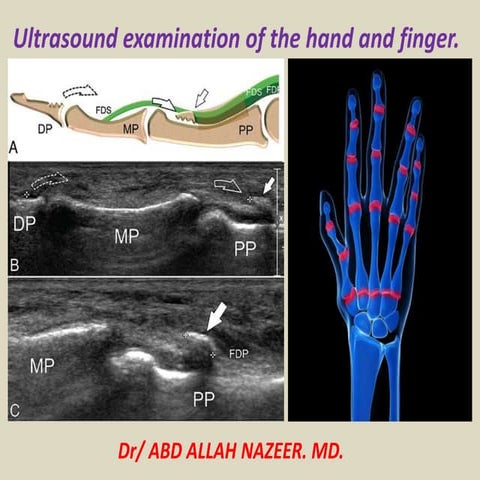 Presentation1.pptx, ultrasound of the hand and fingers. | PPTX