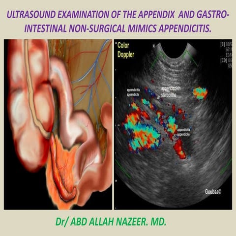 Imaging in Appendicitis