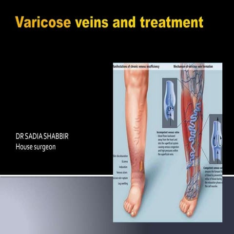 Varicose vein [ chronic venous incompetent.pptx