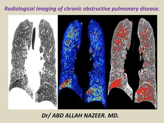 Bronchiectasis.pptx