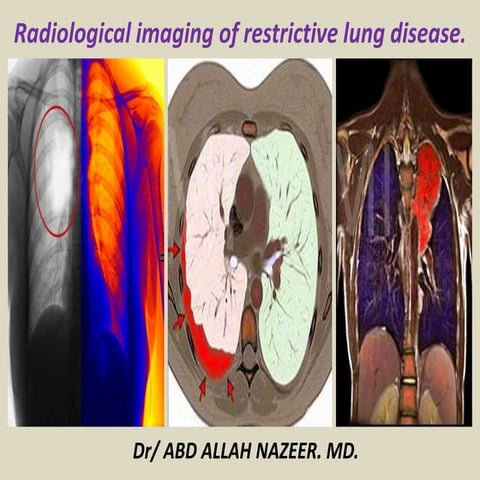 Presentation1.pptx, radiological imaging of restrictive lung diseases ...