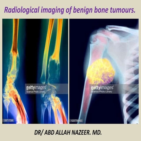 Presentation1.pptx, radiological imaging of benign bone tumour. | PPTX