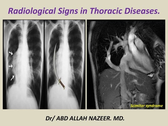 Radiographic signs in bronchiectasis | PPTX