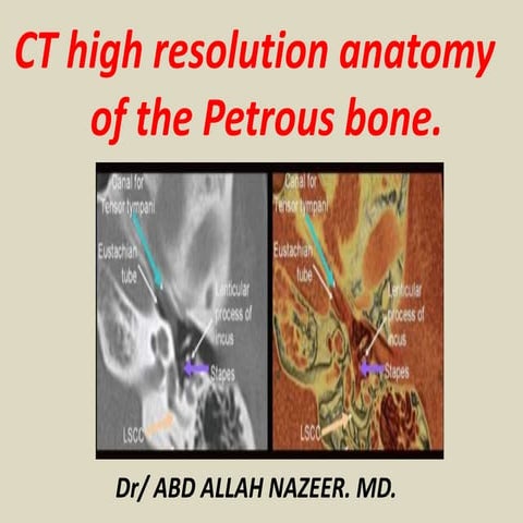 Presentation1.pptx, ct high resolution anatomy of the petrous bone. | PPT