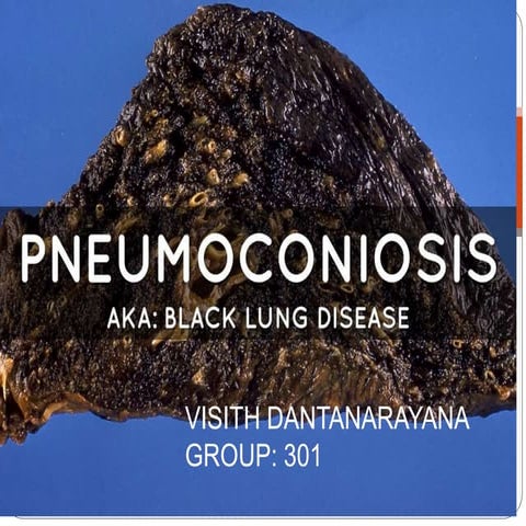 Pneumoconiosis | PPTX